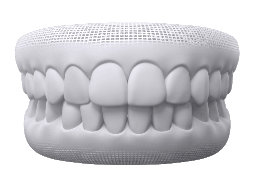 Underbite Correction Without Surgery