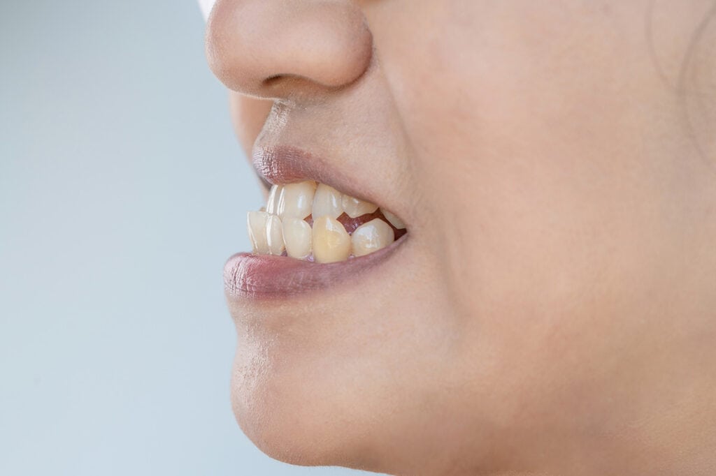 Transform Your Smile: Underbite Treatment Before & After BHO