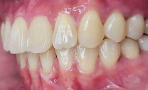 Overbite: Before and After Treatment at BHO