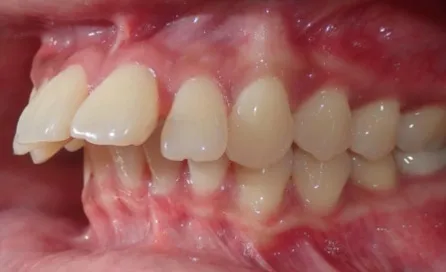 Transform Your Smile: Overbite Treatment Results at BHO