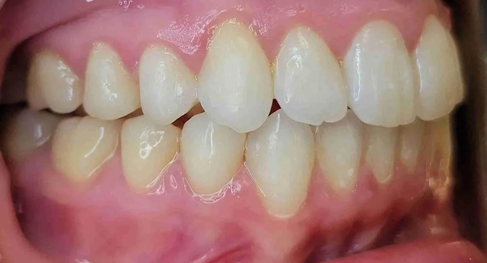 Invisalign Transformations: Before & After Patient Smiles