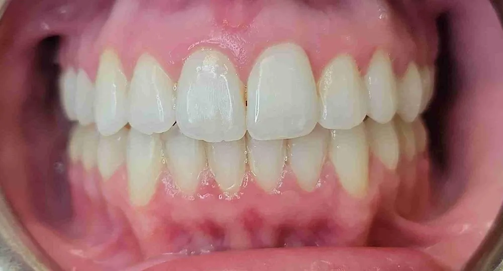Invisalign Transformations: Before & After Patient Smiles