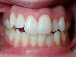 Crossbite: Before and After