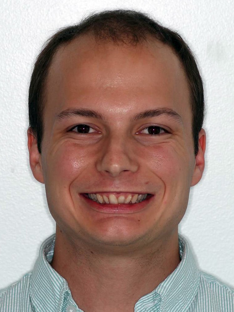 Deep Bite: Before and After