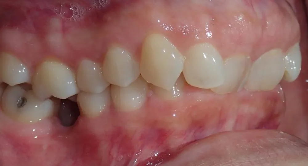 Deep Bite Face Change: Before and After Transformations