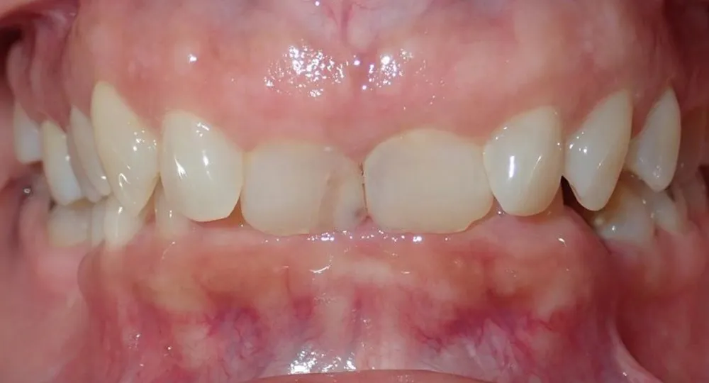 Deep Bite Face Change: Before and After Transformations