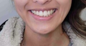 Black Triangle: Before and After