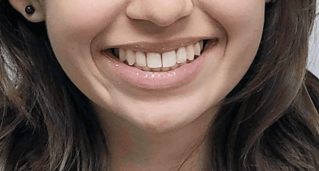 Before & After Transformations of Crooked Teeth