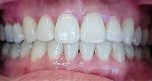 Black Triangle: Before and After