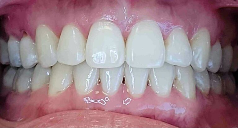 Black Triangle: Before and After