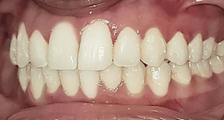 Crooked Teeth: Before and After