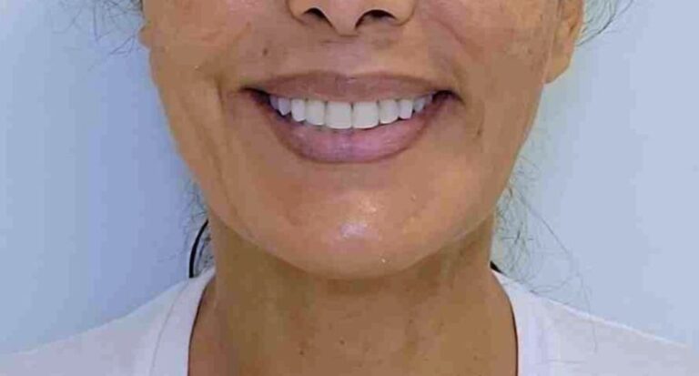 Black Triangle: Before and After