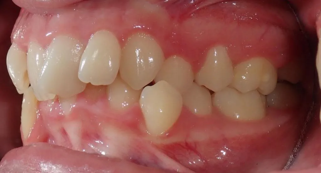 Before & After Transformations of Crooked Teeth