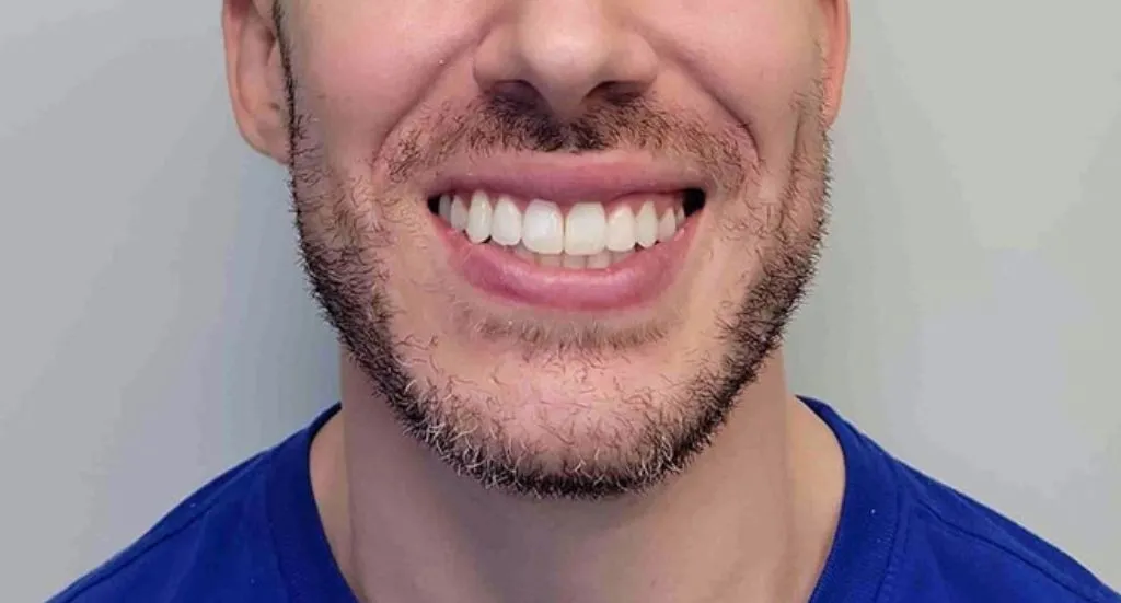 Transformed Smiles: Crossbite Before & After Success Stories