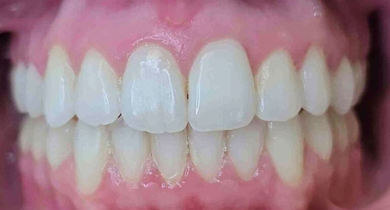 Crossbite: Before and After