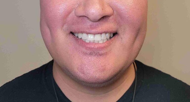 Crossbite: Before and After