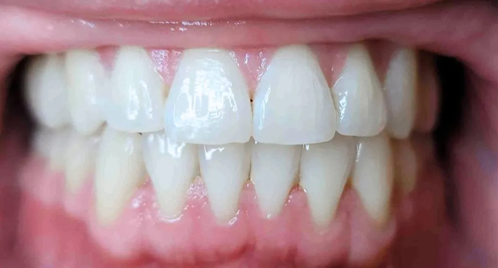 Invisalign Transformations: Before & After Patient Smiles