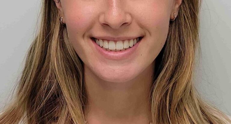 Crossbite: Before and After