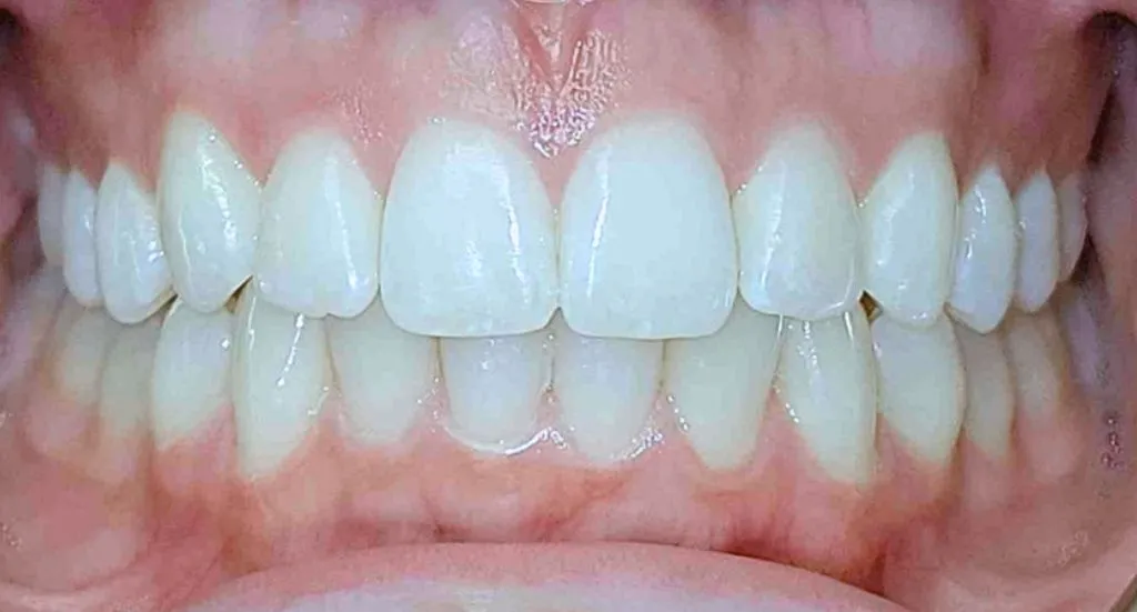 Transformed Smiles: Crossbite Before & After Success Stories