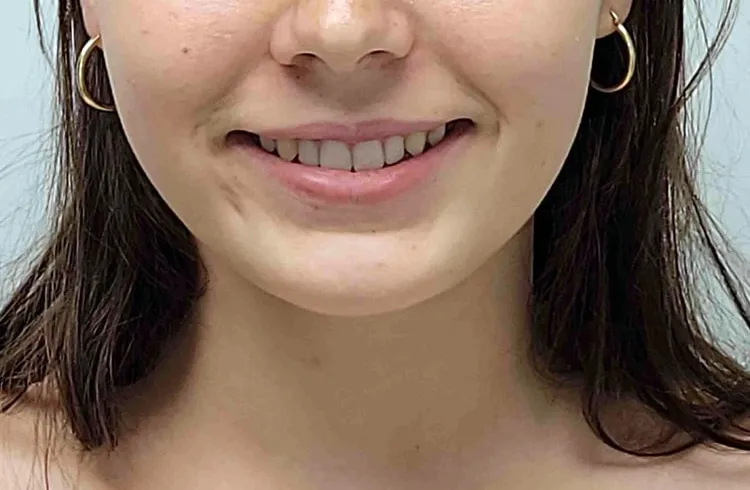 Deep Bite Face Change: Before and After Transformations