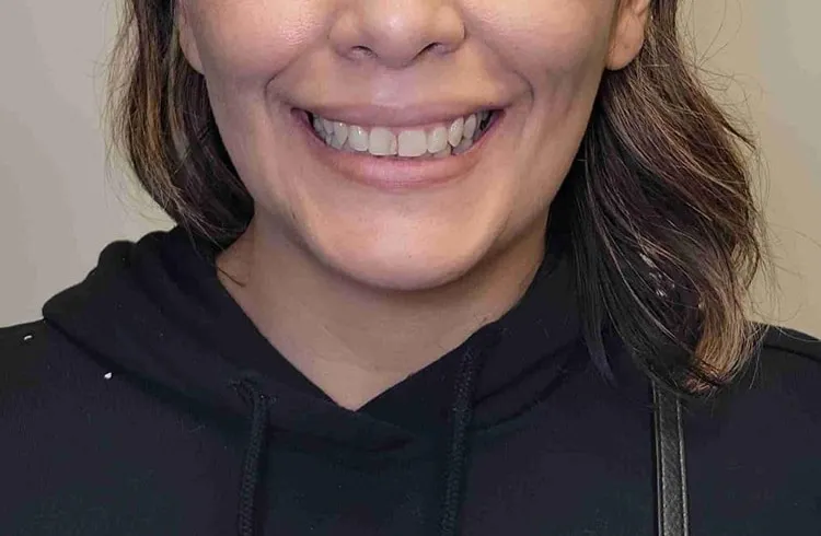 Deep Bite Face Change: Before and After Transformations