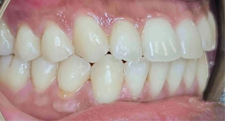 Open Bite: Before and After