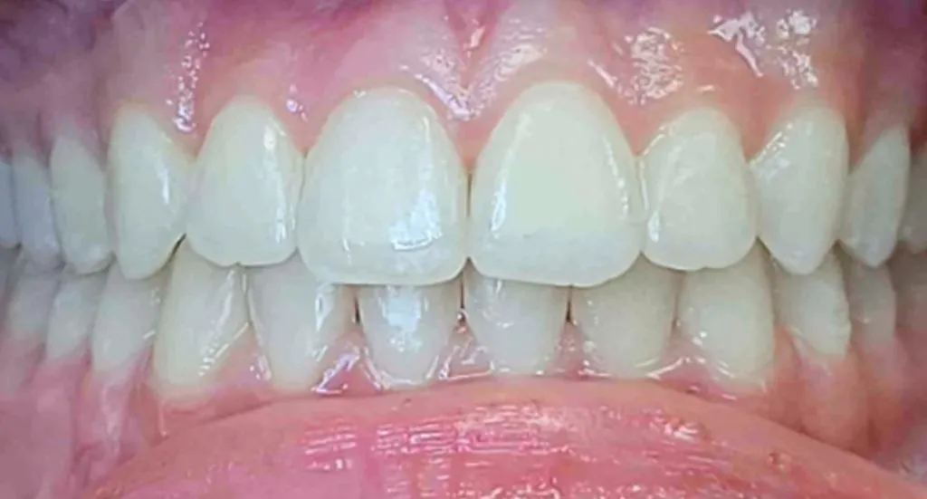 Open Bite Treatment: Stunning Before and After Results