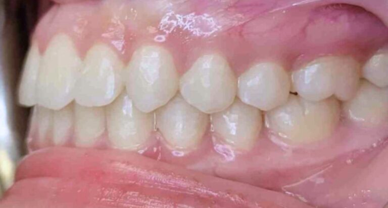 Open Bite: Before and After