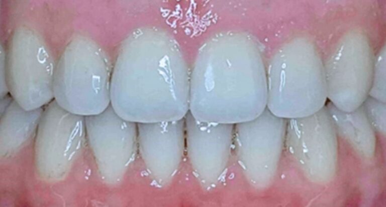 Open Bite: Before and After