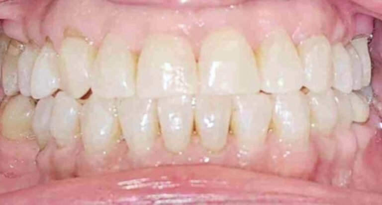 Open Bite: Before and After