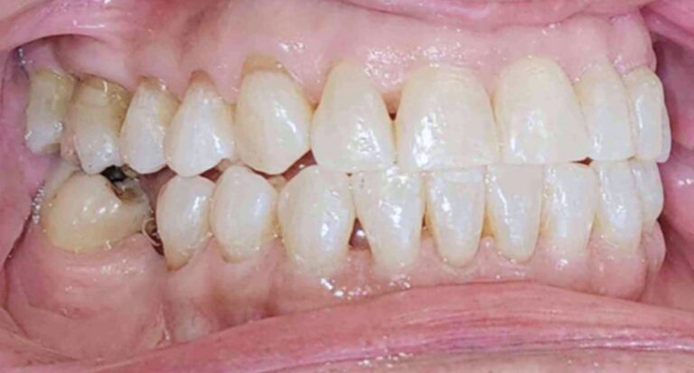 Open Bite: Before and After