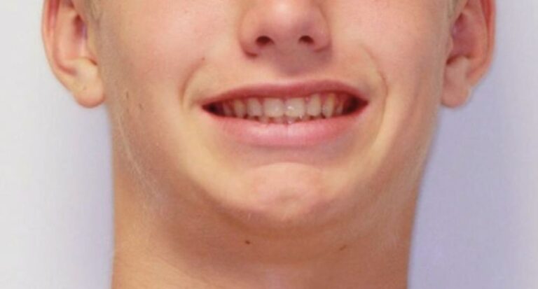 Overbite: Before and After Treatment at BHO