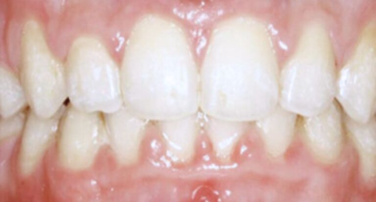 Overbite: Before and After Treatment at BHO