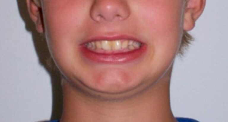 Overbite: Before and After Treatment at BHO