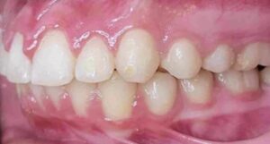 Overbite: Before and After Treatment at BHO