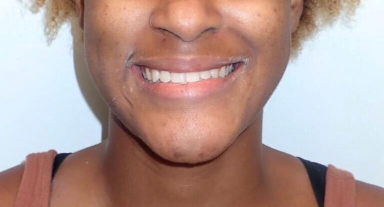 Underbite: Before and After Treatment at BHO