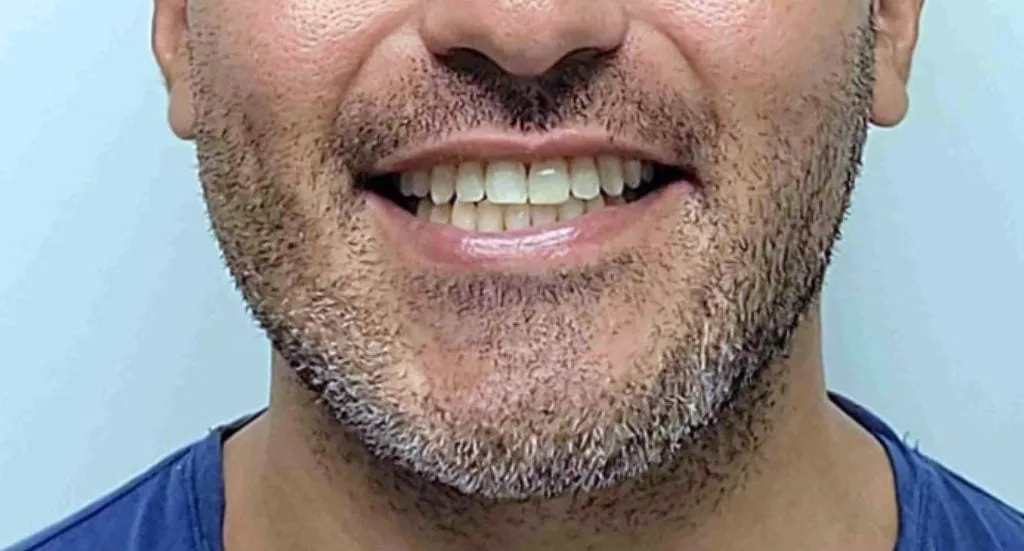 Transform Your Smile: Underbite Treatment Before & After BHO