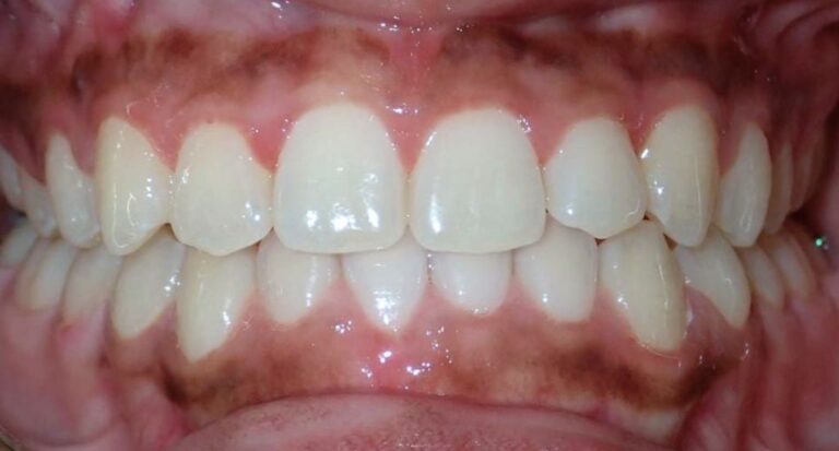 Underbite: Before and After Treatment at BHO