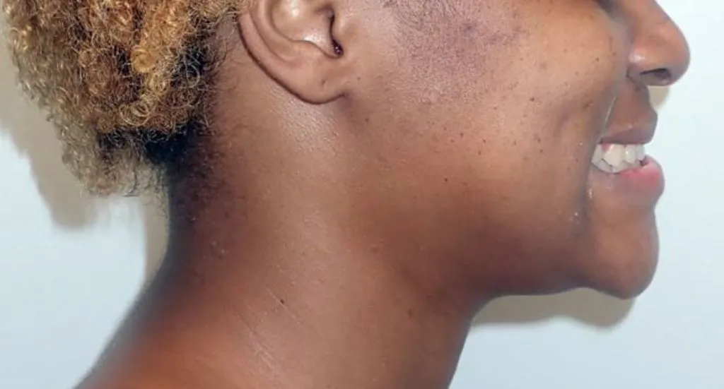 Transform Your Smile: Underbite Treatment Before & After BHO