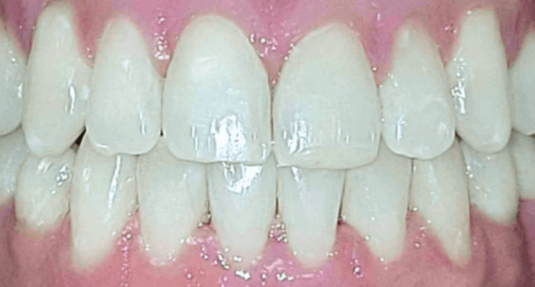 Transform Your Smile: Underbite Treatment Before & After BHO