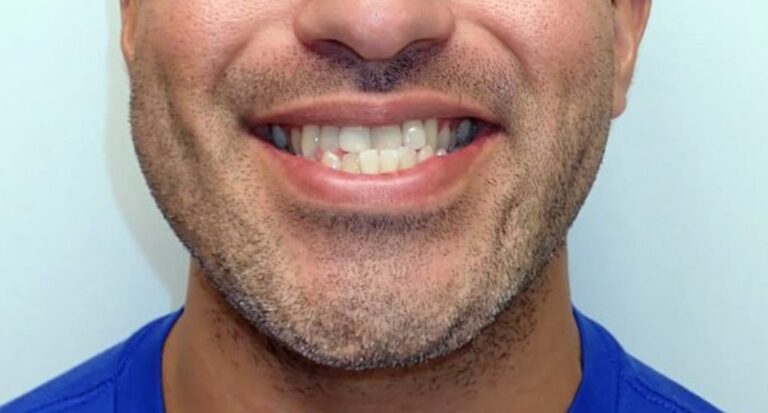 Underbite: Before and After Treatment at BHO
