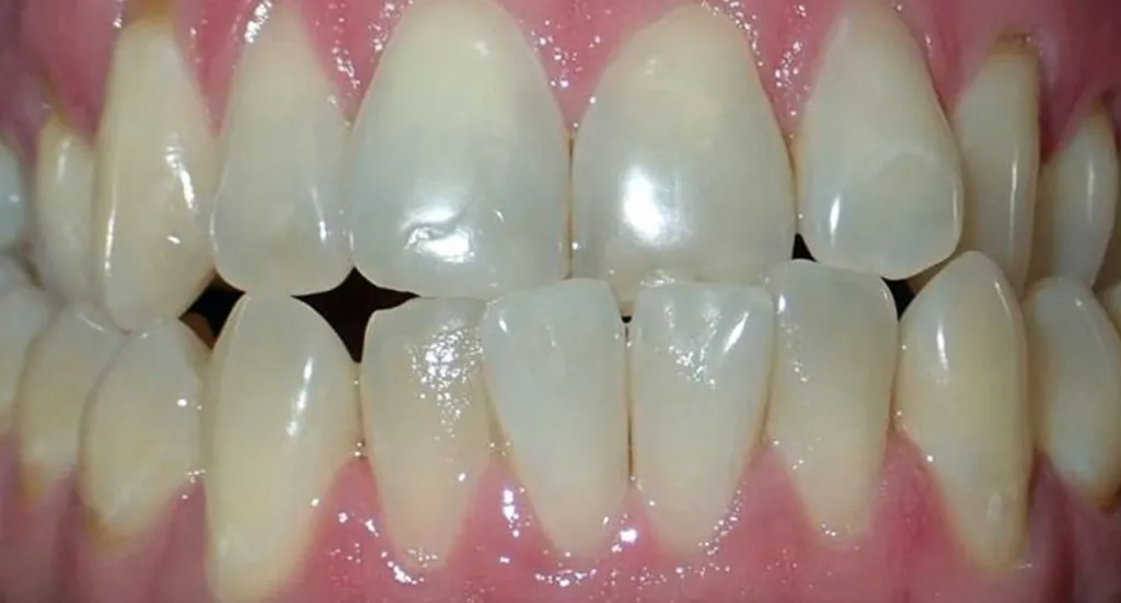 Transform Your Smile: Underbite Treatment Before & After BHO