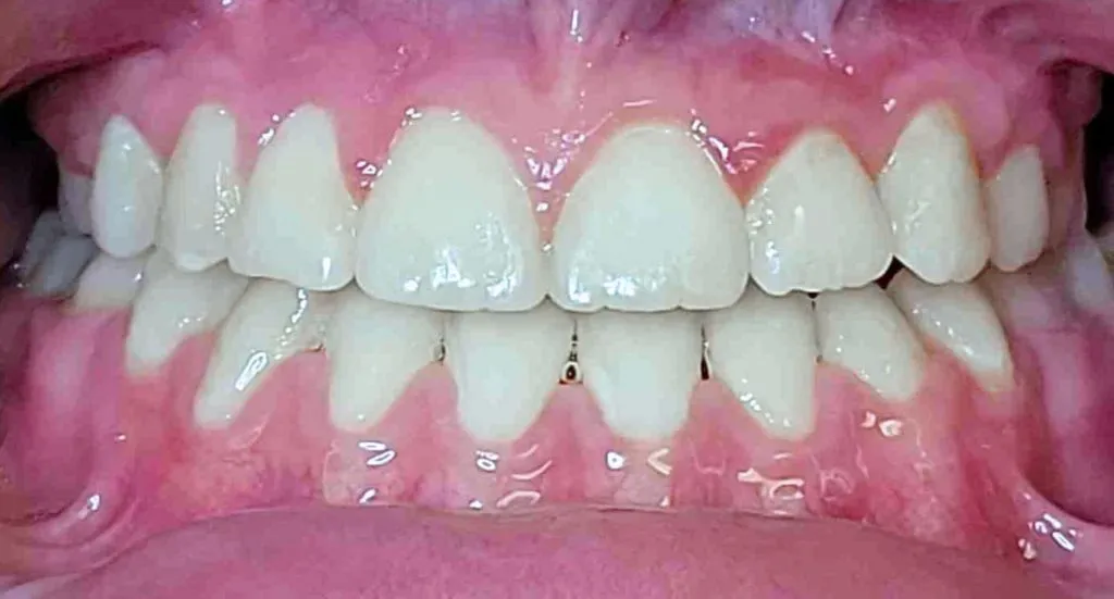 Underbite Teeth Nhs