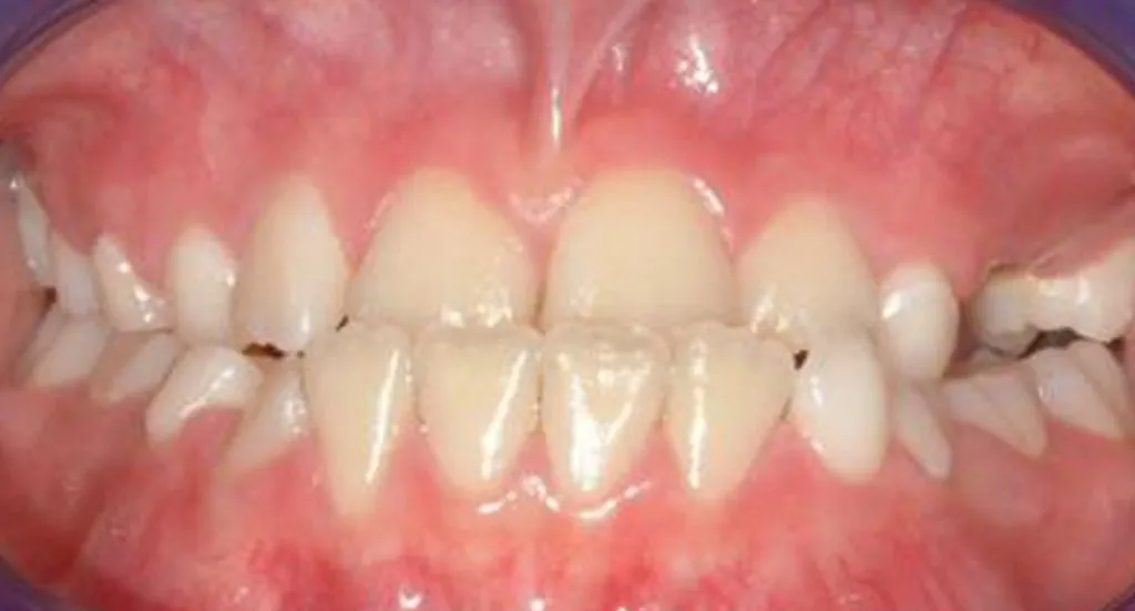 Transform Your Smile: Underbite Treatment Before & After BHO