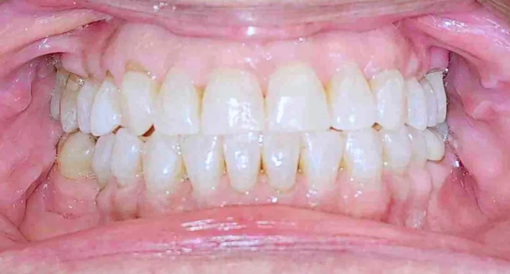 Invisalign Transformations: Before & After Patient Smiles