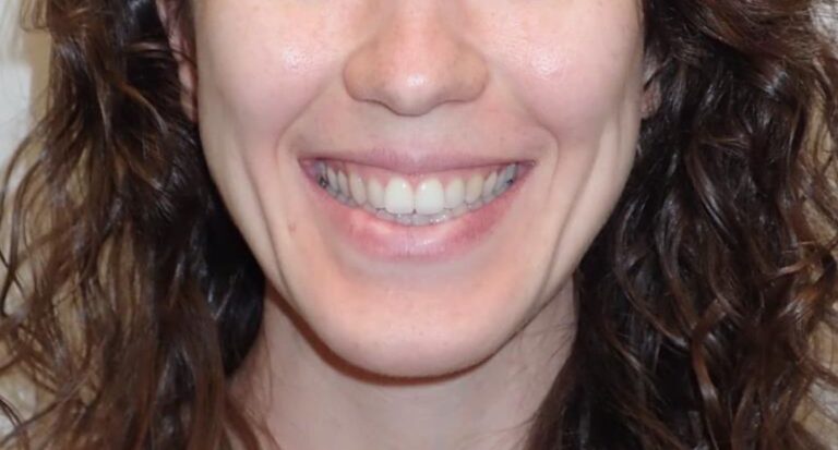 Invisalign Transformations: Before & After Patient Smiles