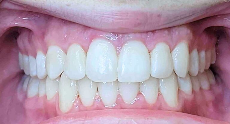 Crowded Teeth: Before and After