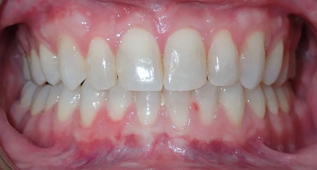 Deep Bite Face Change: Before and After Transformations