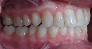 Deep Bite Face Change: Before and After Transformations