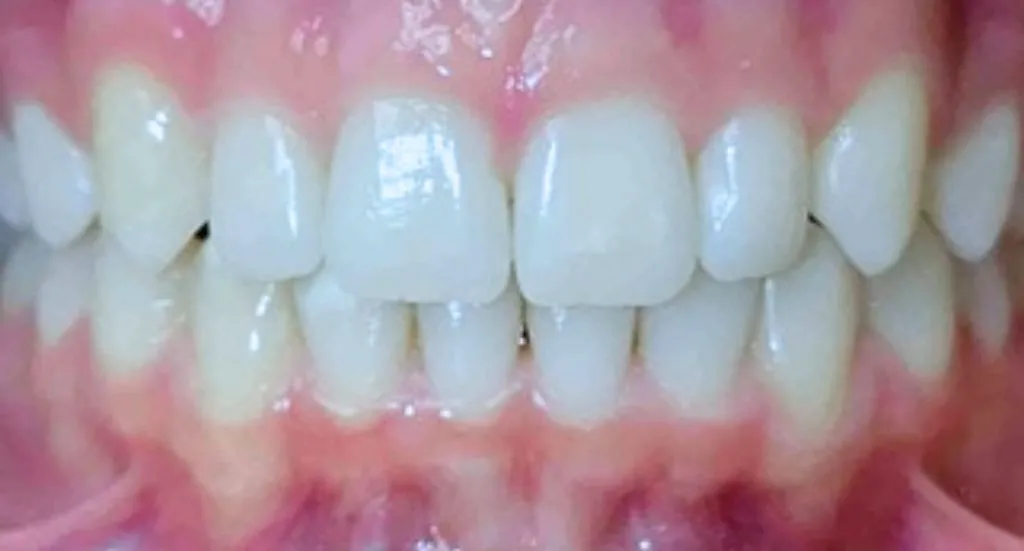 Deep Bite Face Change: Before and After Transformations